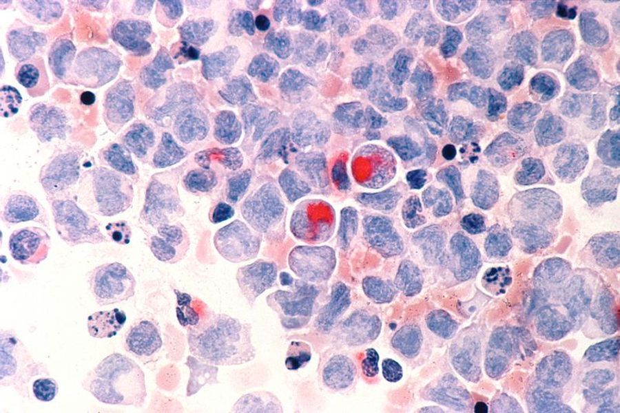 More Accurate Leukemia Diagnosis Expected with Refined Classification ...