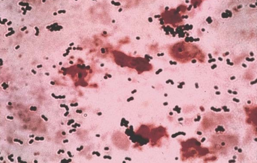 Advantage of Universal Group B Streptococcus Screening for Pregnant ...