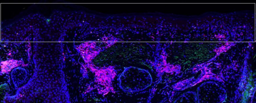Immunotherapy of Precancerous Skin Lesions May Prevent Squamous Cell ...