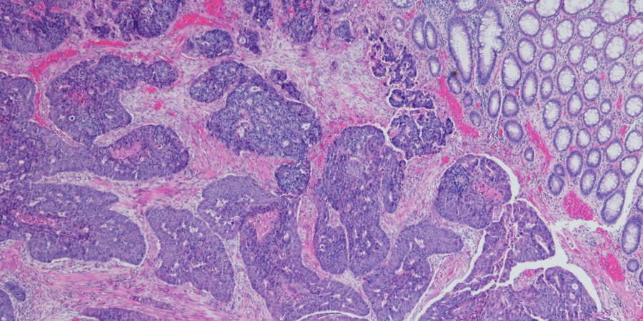 Study Shows Advanced Colorectal Cancers at Recommended Screening Age ...