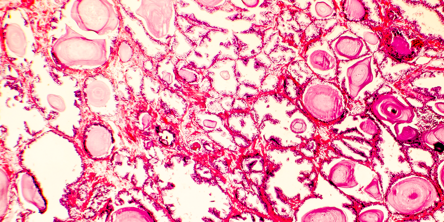 New Recommendations on Genetic Testing for Prostate Cancer | Today's ...