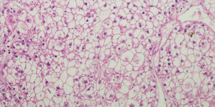 New Blood Test Developed to Improve Liver Cancer Screening | Today's ...