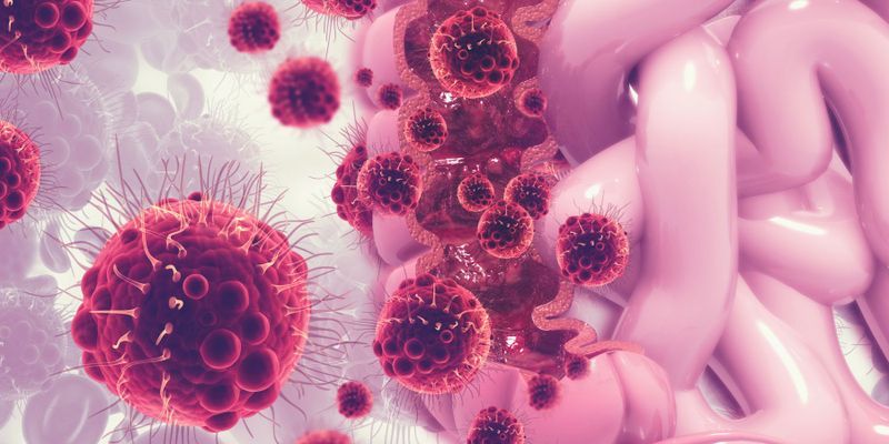 New Liquid Biopsy IDs Lymph Node Metastasis in Early-Stage T1 ...