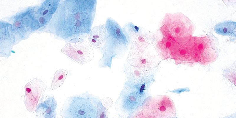 Self-Sampling for HPV-Based Cervical Screening | Today's Clinical Lab
