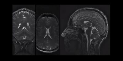 New MRI Technique Captures Brain Movement in Stunning Detail | Today's ...