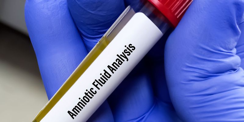 Diagnostic Potential of Amniotic Fluid Cells in Deciphering Rare ...