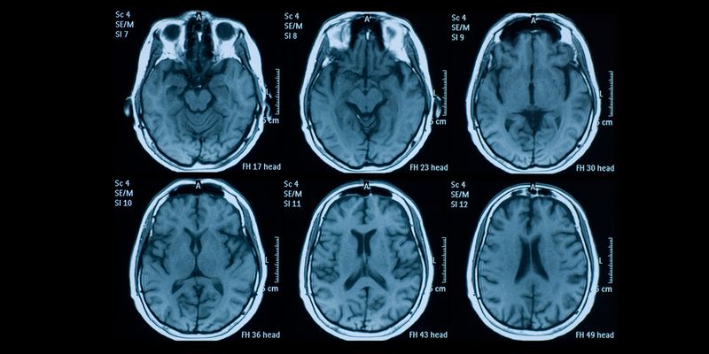 New Way to Measure Brain Oxygen Levels in Patients | Today's Clinical Lab