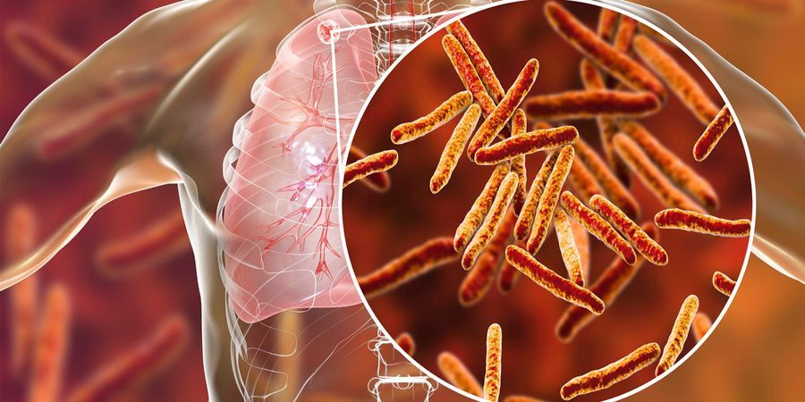Study Maps Genetics of Early Progression in TB | Today's Clinical Lab